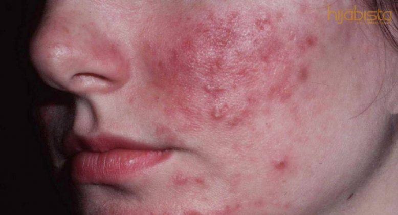 Atasi Kulit Kemerahan & Kegatalan, Rangkaian Produk Baharu Ini Beri ...