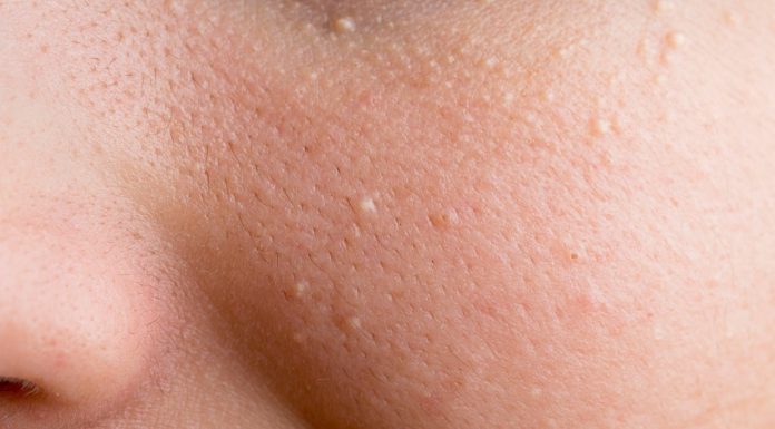 Milia Seed Atau Baby Pimples Pada Wajah Buat Rasa Rimas Sebab Itu Kena ...