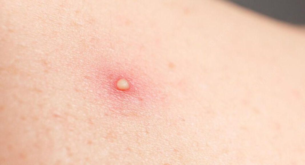 Benarkah Bisul Di Punggung Disebabkan Habit Duduk Atas Bantal?
